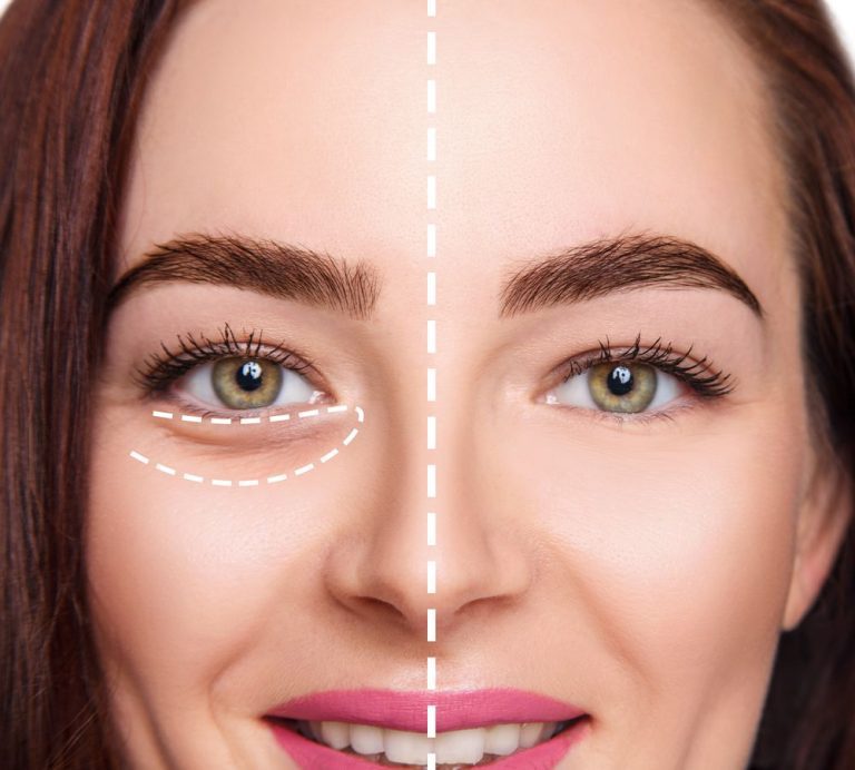 Chemical Peels and Thread Lifts - Sullivan Dermatology